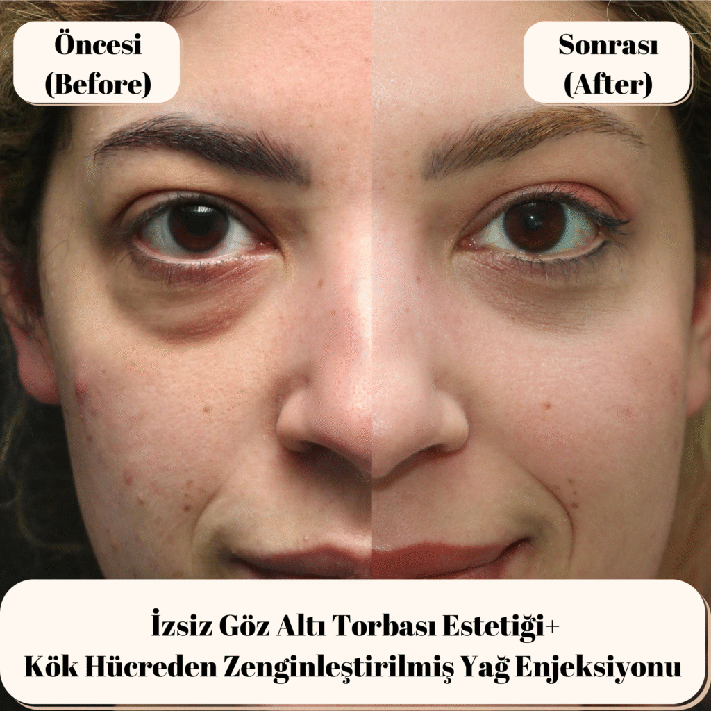 Blepharoplasty and Periocular Rejuvenation - Dr Mert Ersan